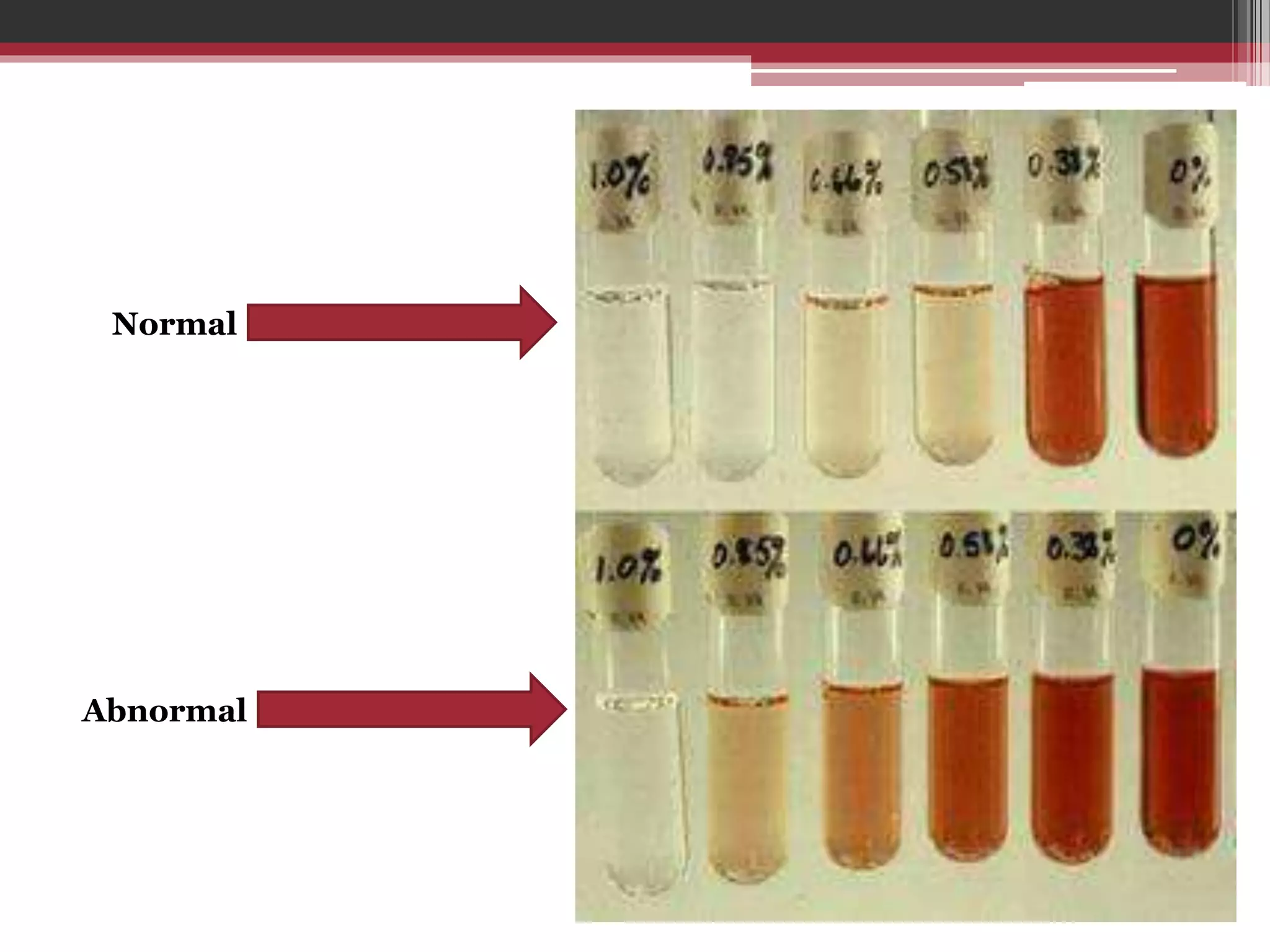 Haemolytic anemias due to cell membrane defects | PPT