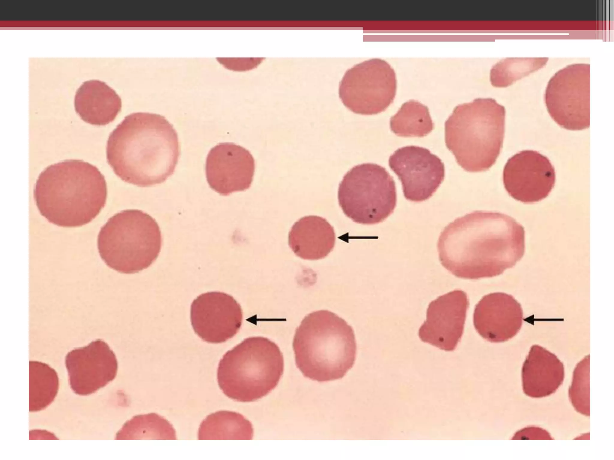 Haemolytic anemias due to cell membrane defects | PPT