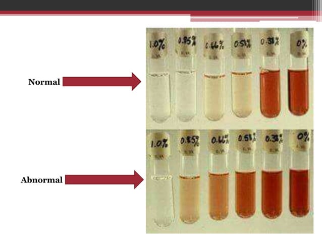 Haemolytic anemias due to cell membrane defects | PPT