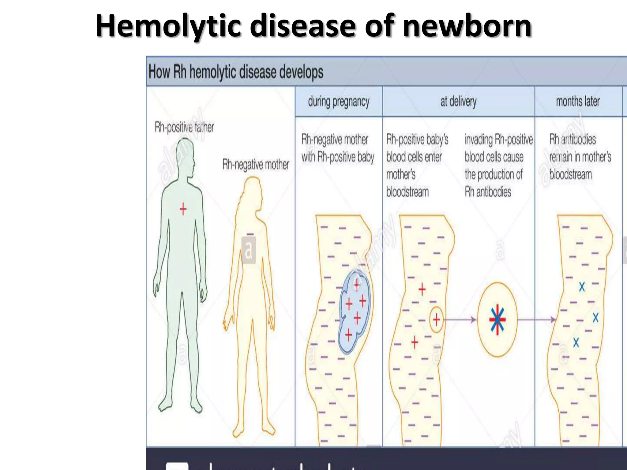 HAEMOLYTIC DISEASE OF THE NEW BORN (HDN).pptx