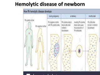 HAEMOLYTIC DISEASE OF THE NEW BORN (HDN).pptx