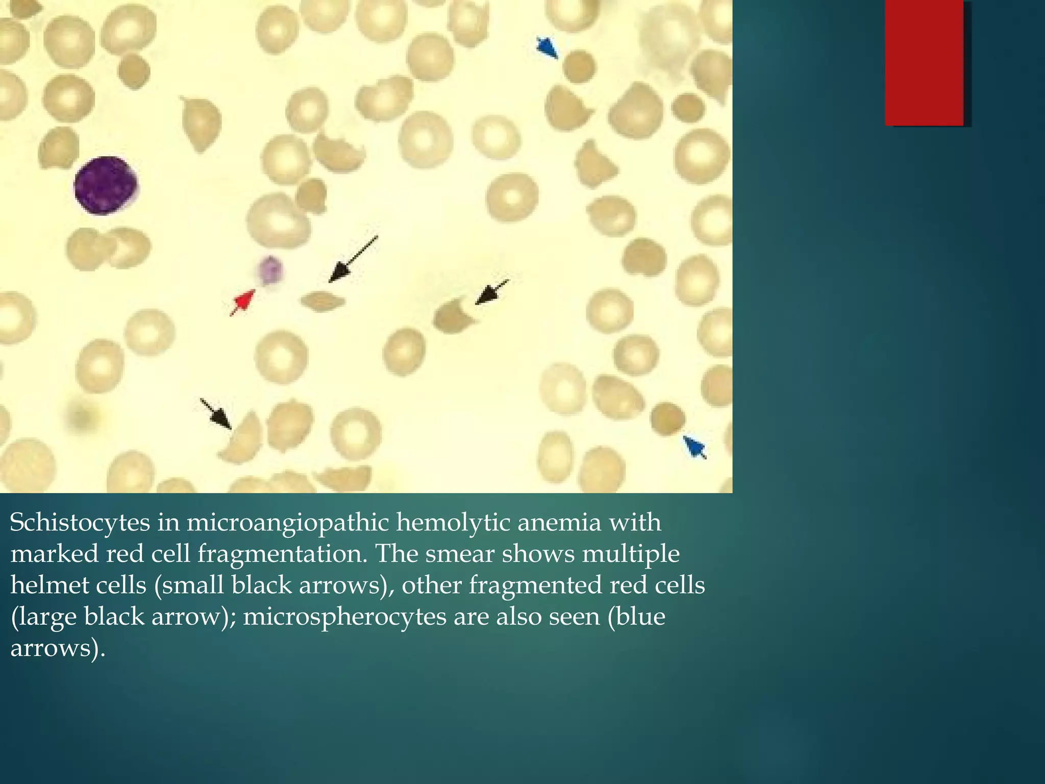 Haemolytic disorders | PPT
