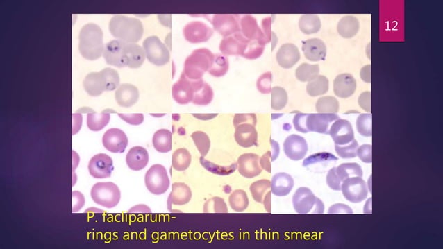Haemoparasites in blood smear | PPTX | Blood Disorders | Diseases and ...