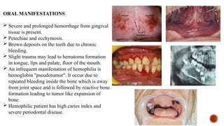 Haemophilia and types of hemophilia (Royal diseases) | PPTX