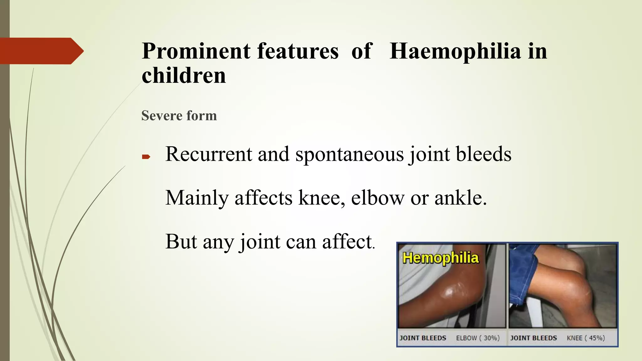 Haemophilia in children | PPTX