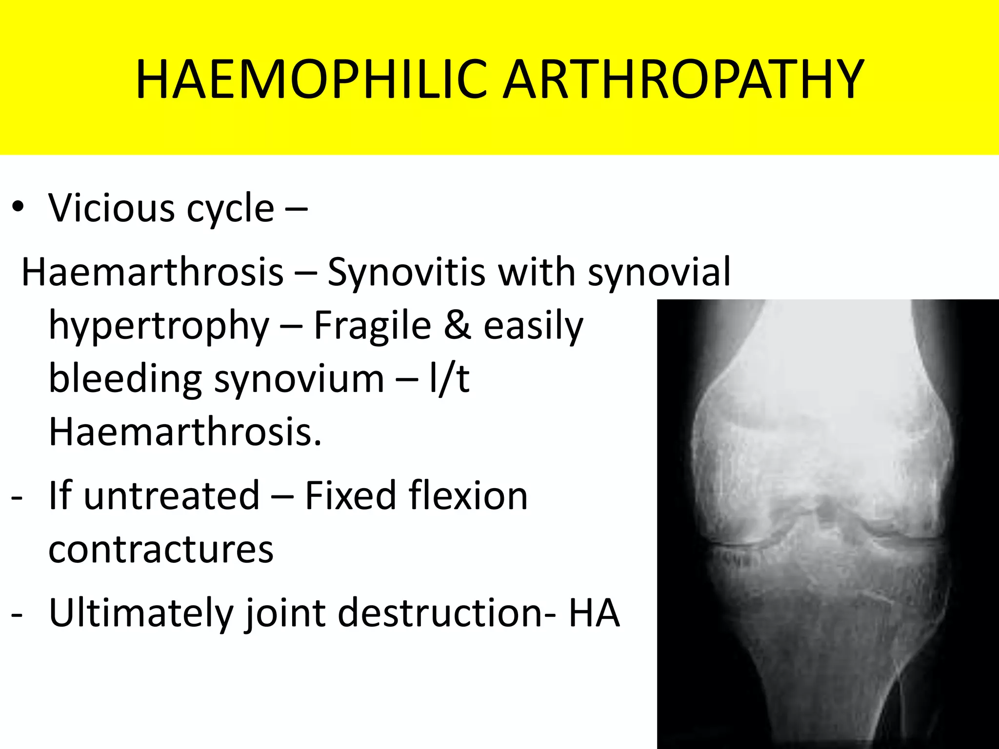 Haemophilia & orthopaedics | PPTX