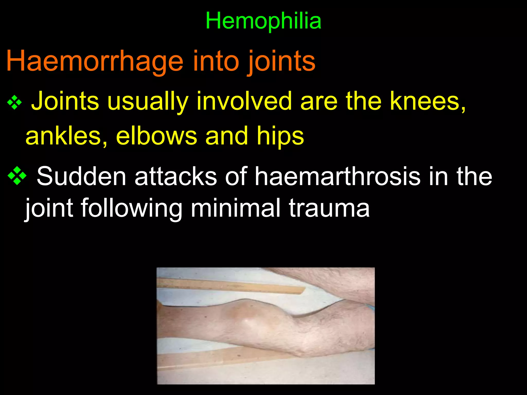 Haemophilic arthritis1 | PPT