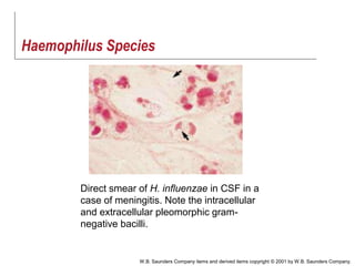 Haemophilus Influenzae Type B Gram Stain
