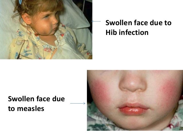 Haemophilus influenzae