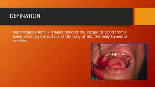 Haemorrhage | PPTX