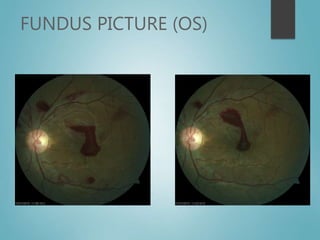 Haemorrhagic retinopathy with hemolytic anaemia | PPTX