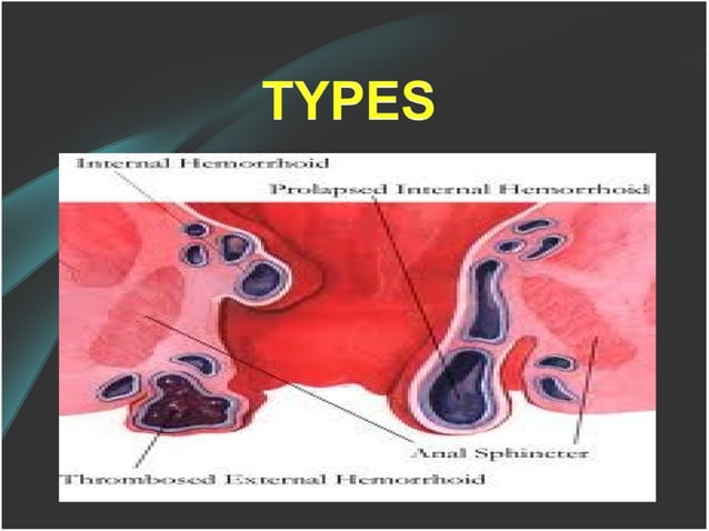 Haemorrhoid | PPT | Blood Disorders | Diseases and Conditions