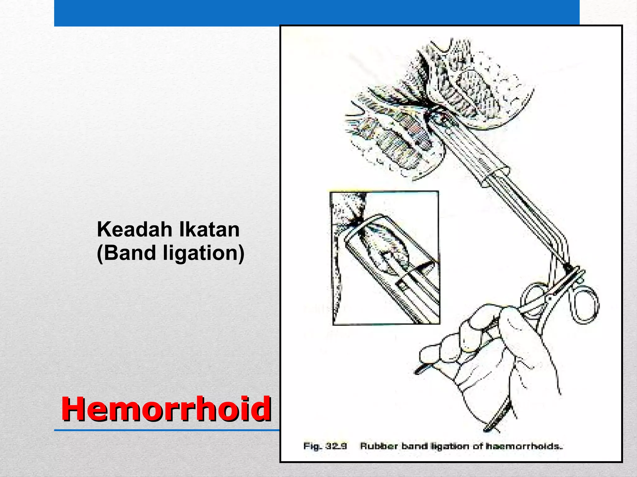 HAEMORRHOID | PPT