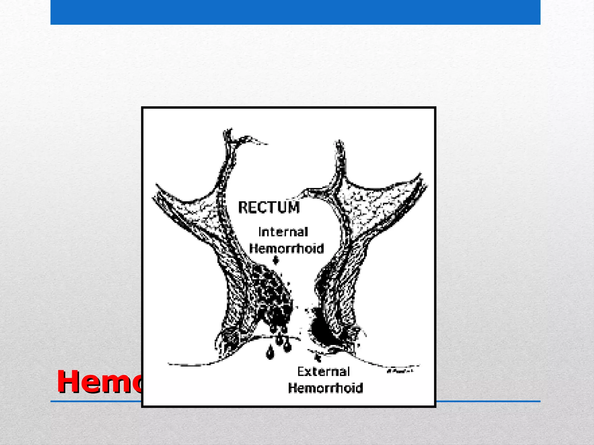 HAEMORRHOID | PPT