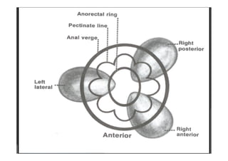 Haemorrhoids | PDF