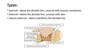 Overview on Haemorrhoids - Fissure - Fistula | PPT