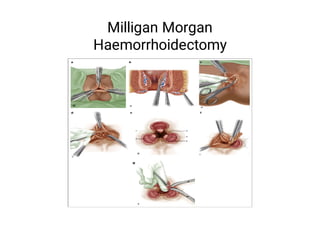 Haemorroids,fissure,fistula in ano | PDF