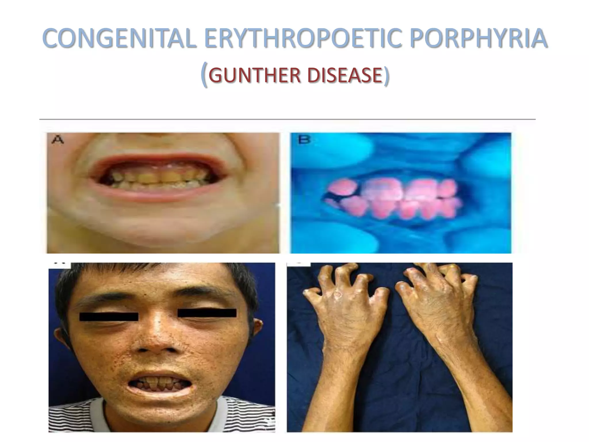 Haem synthesis and porphyria | PPTX | Blood Disorders | Diseases and ...