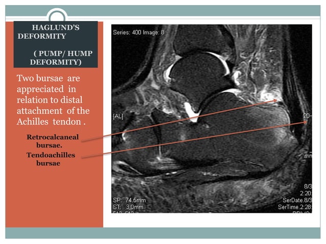 Haglunds deformity | PPT | Foot Health | Diseases and Conditions
