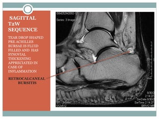 Haglunds deformity | PPT
