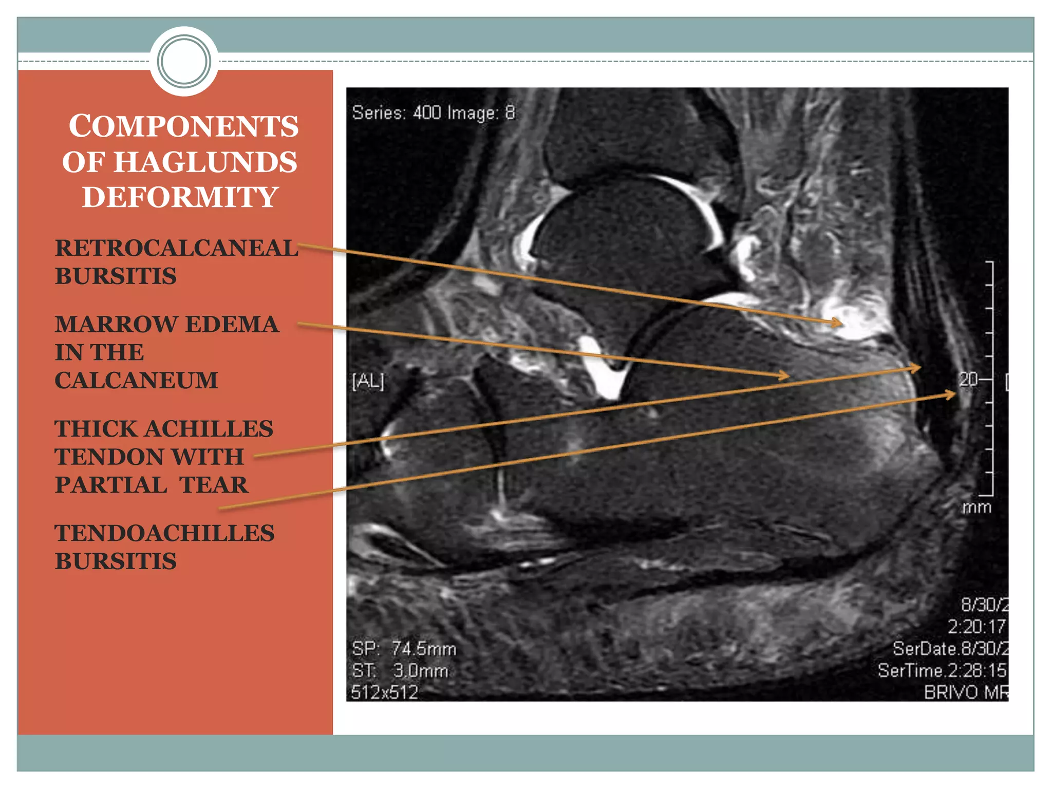 Haglunds deformity presentation | PPTX