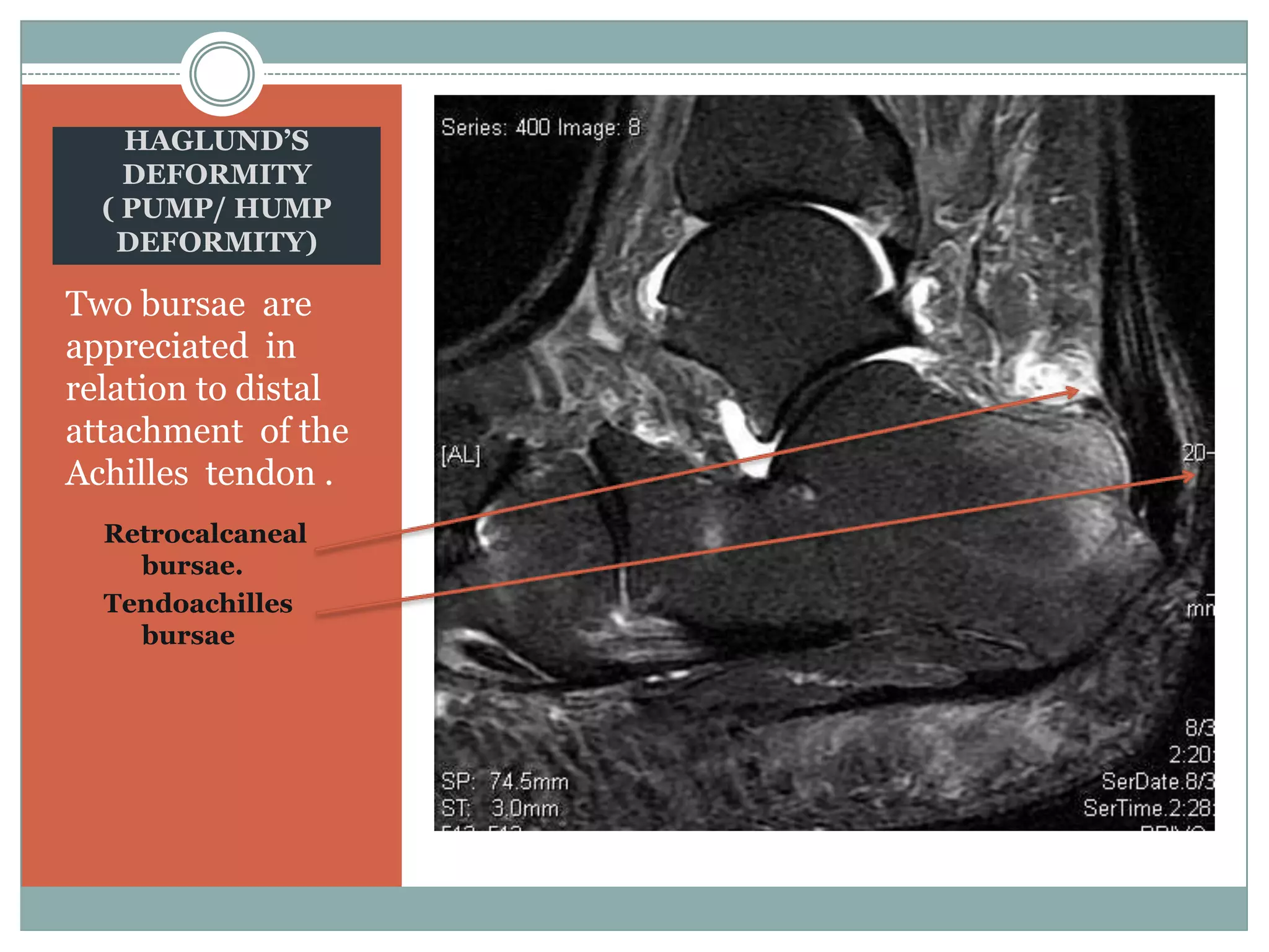 Haglunds deformity presentation | PPT