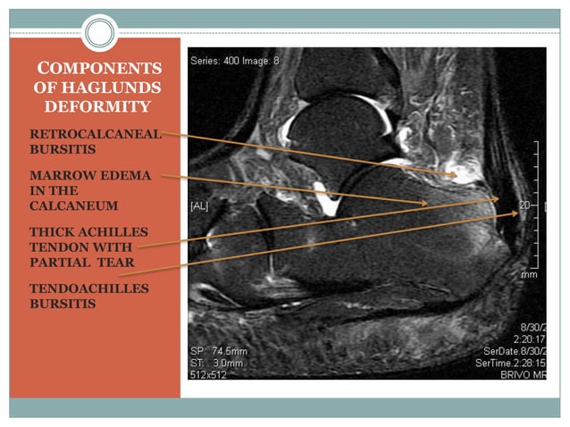 Haglunds deformity presentation | PPTX
