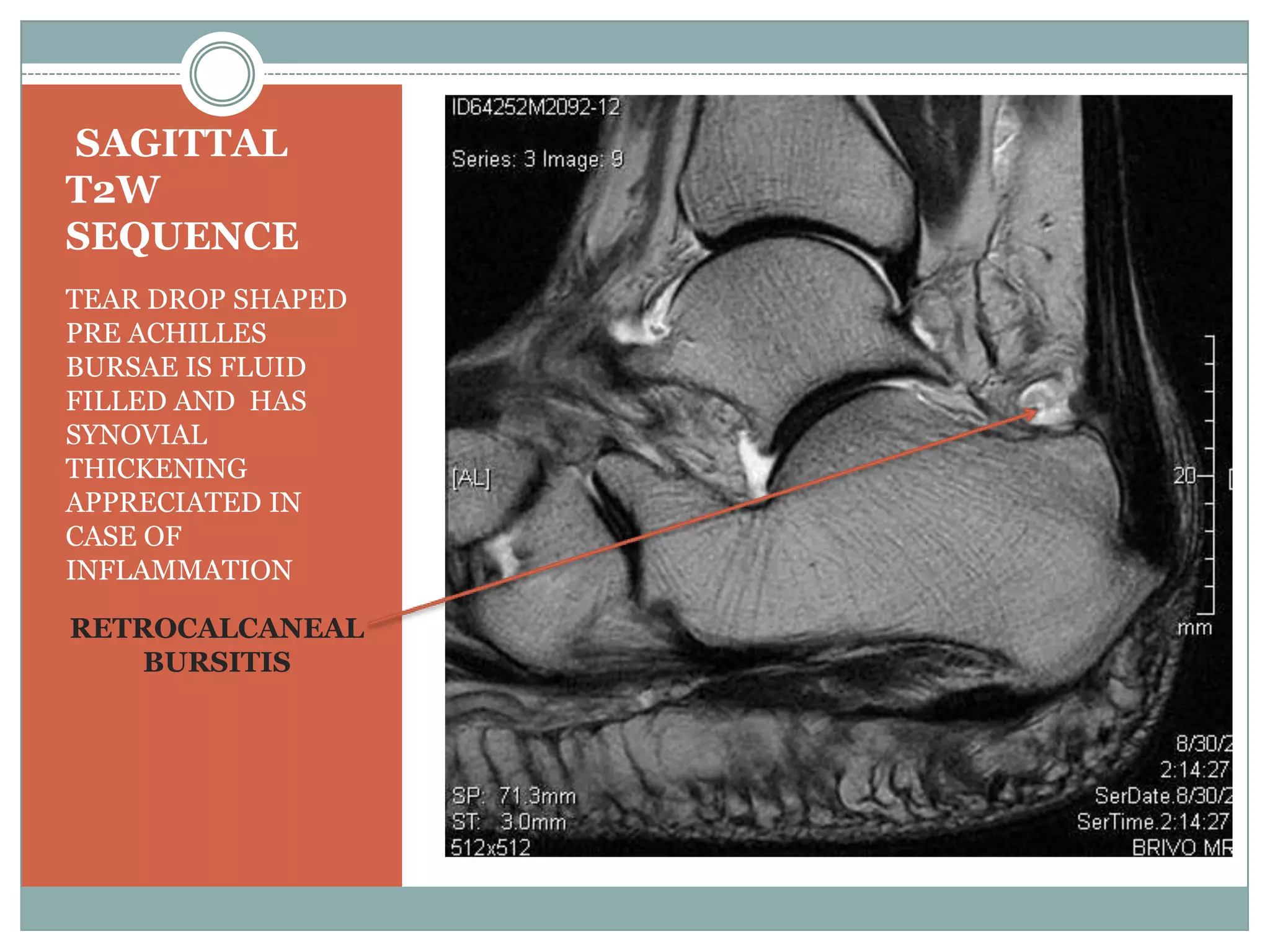 Haglunds deformity presentation | PPTX