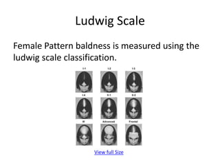 Hair transplant | PPT