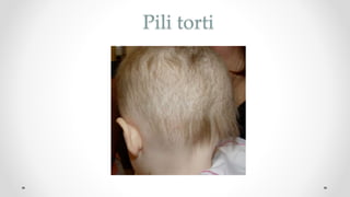 Hair breakage disorders | PPTX | Skin and Dermatology | Diseases and ...