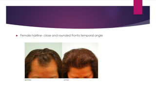 HAIRLINE DESIGNING - Chennai Plastic Surgery | PPTX
