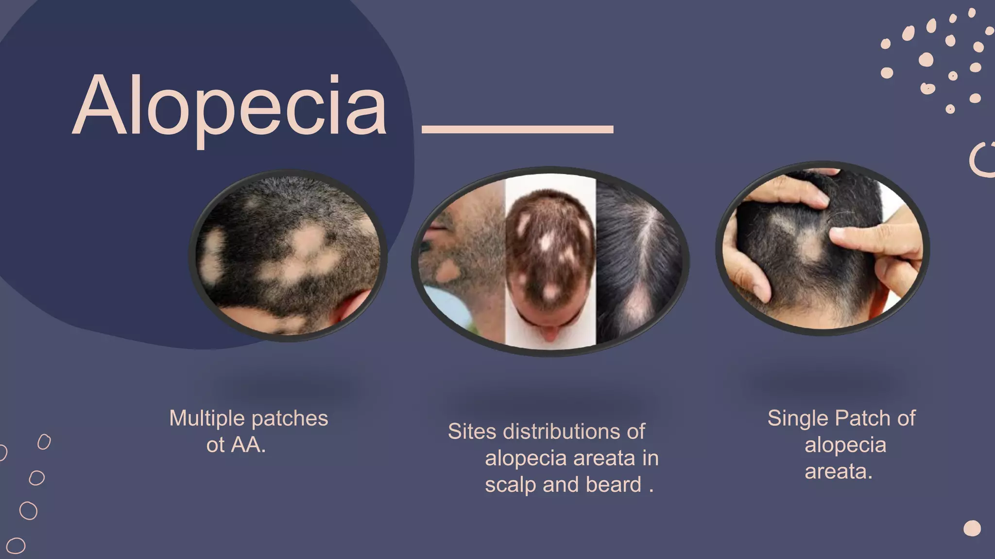 hair disorder | PDF