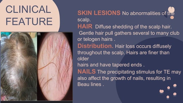 hair disorder | PPT