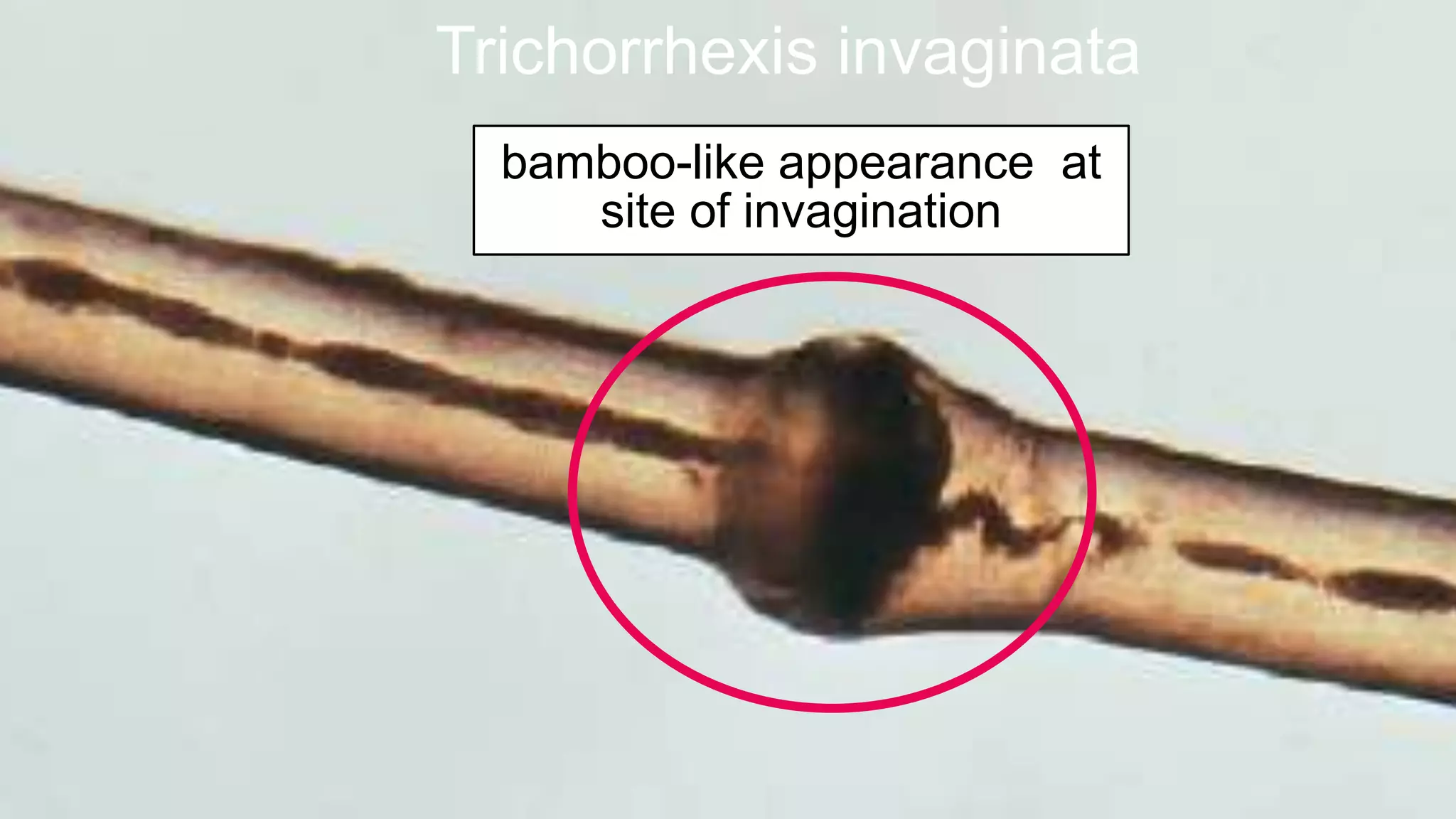 Hair Loss And Trichoscopy Ppt