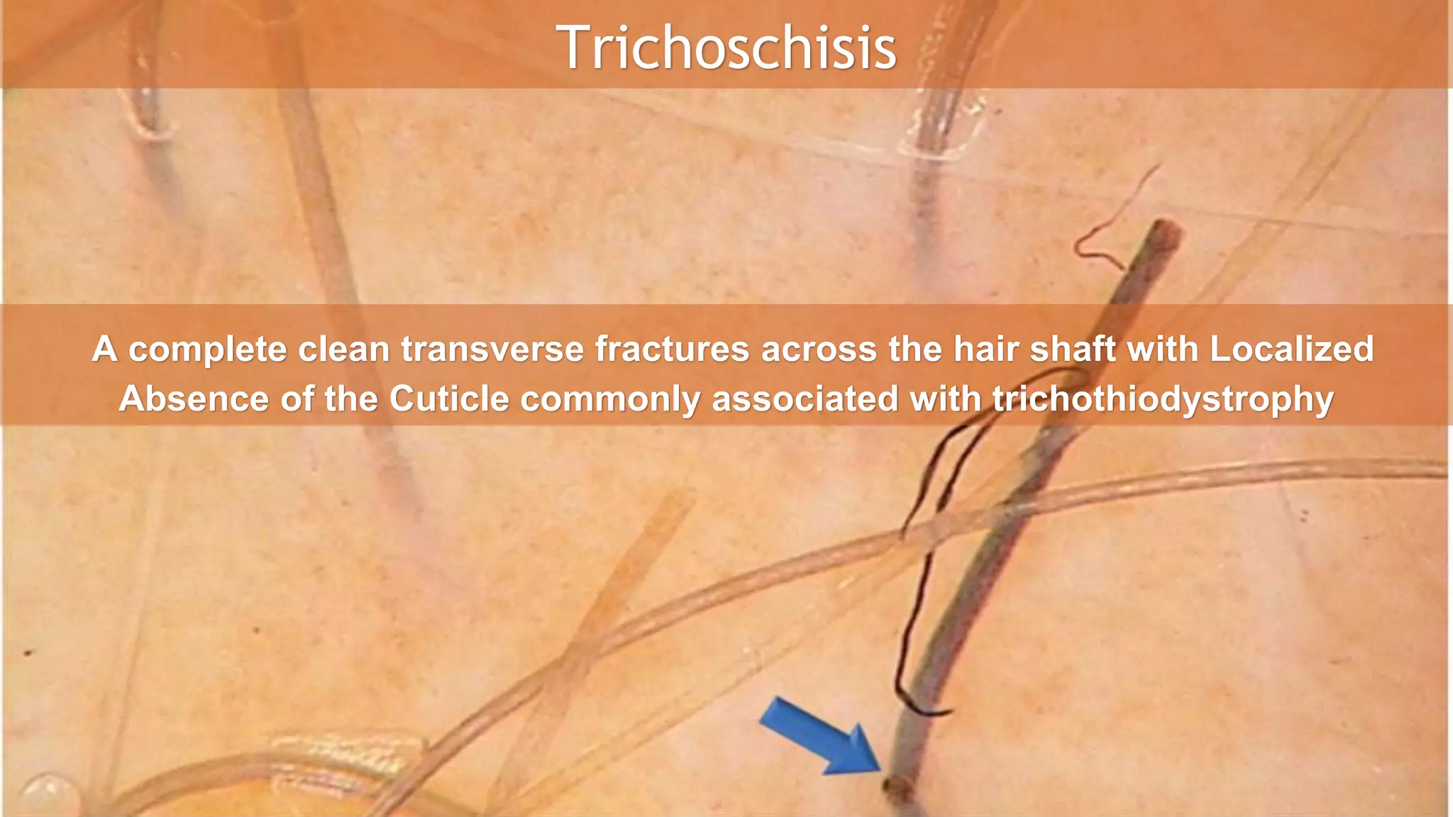 Hair Loss And Trichoscopy Ppt