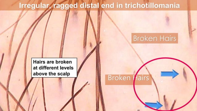 Hair Loss and Trichoscopy | PPTX