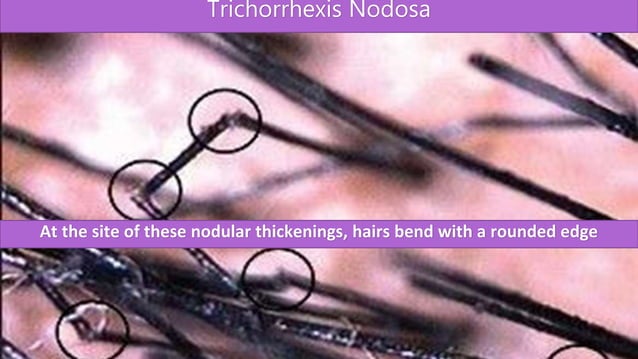 Hair Loss And Trichoscopy Ppt