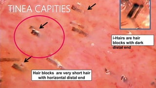 Hair Loss and Trichoscopy | PPTX