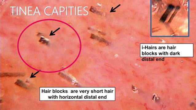 Hair Loss And Trichoscopy Ppt