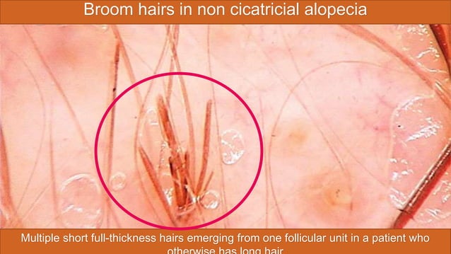 Hair Loss And Trichoscopy Ppt