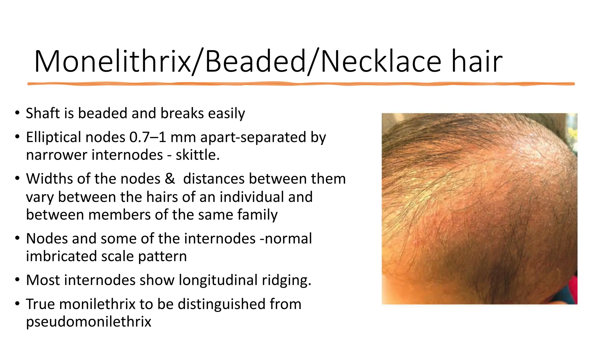 An approach to hair shaft disorders in Dermatology | PDF