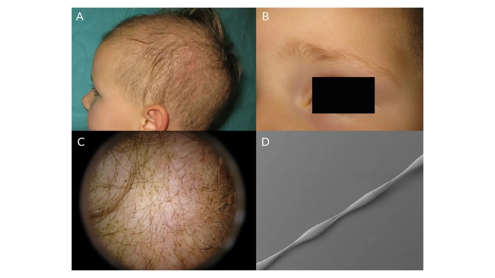 An approach to hair shaft disorders in Dermatology | PDF