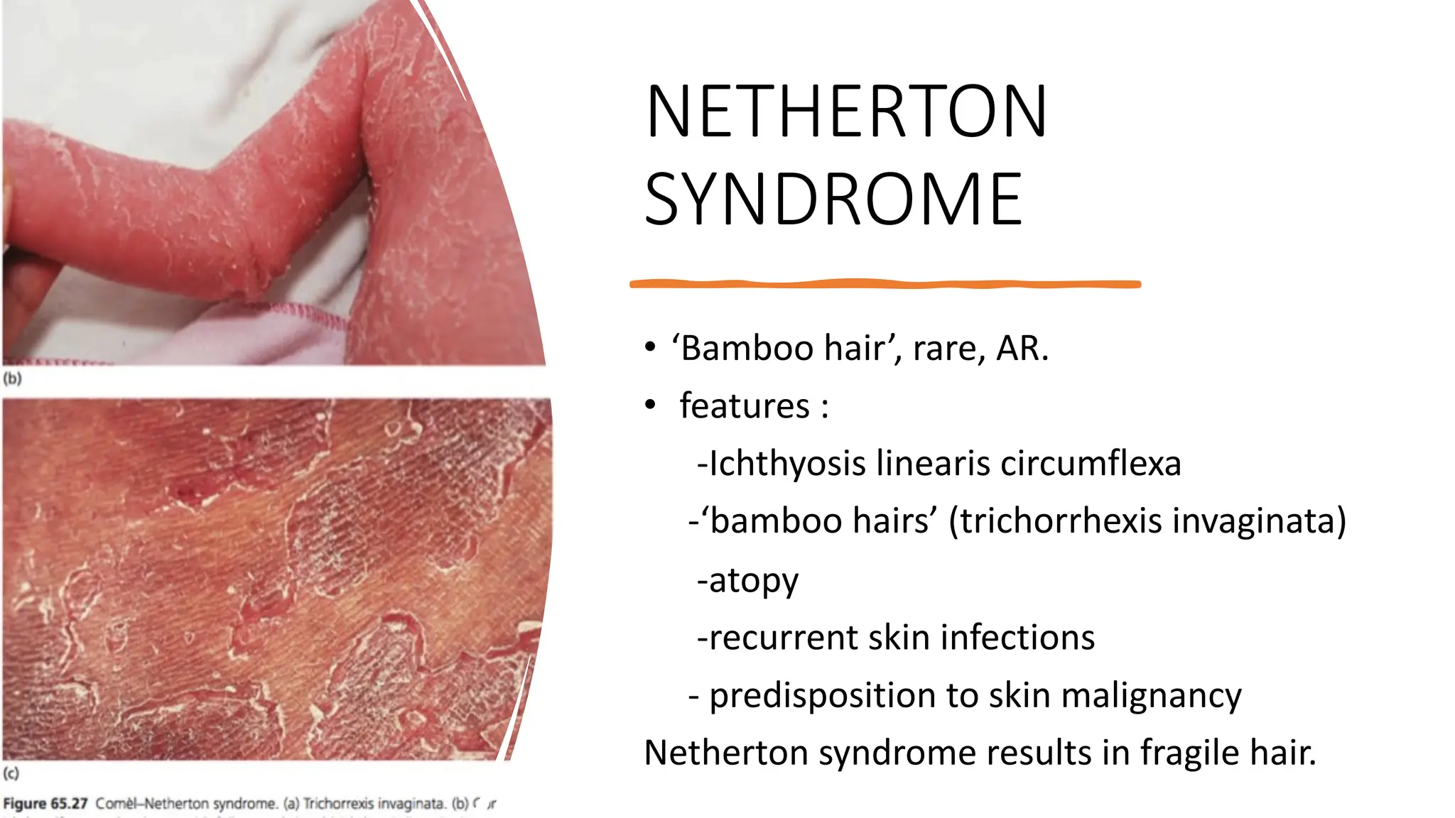 An approach to hair shaft disorders in Dermatology | PDF