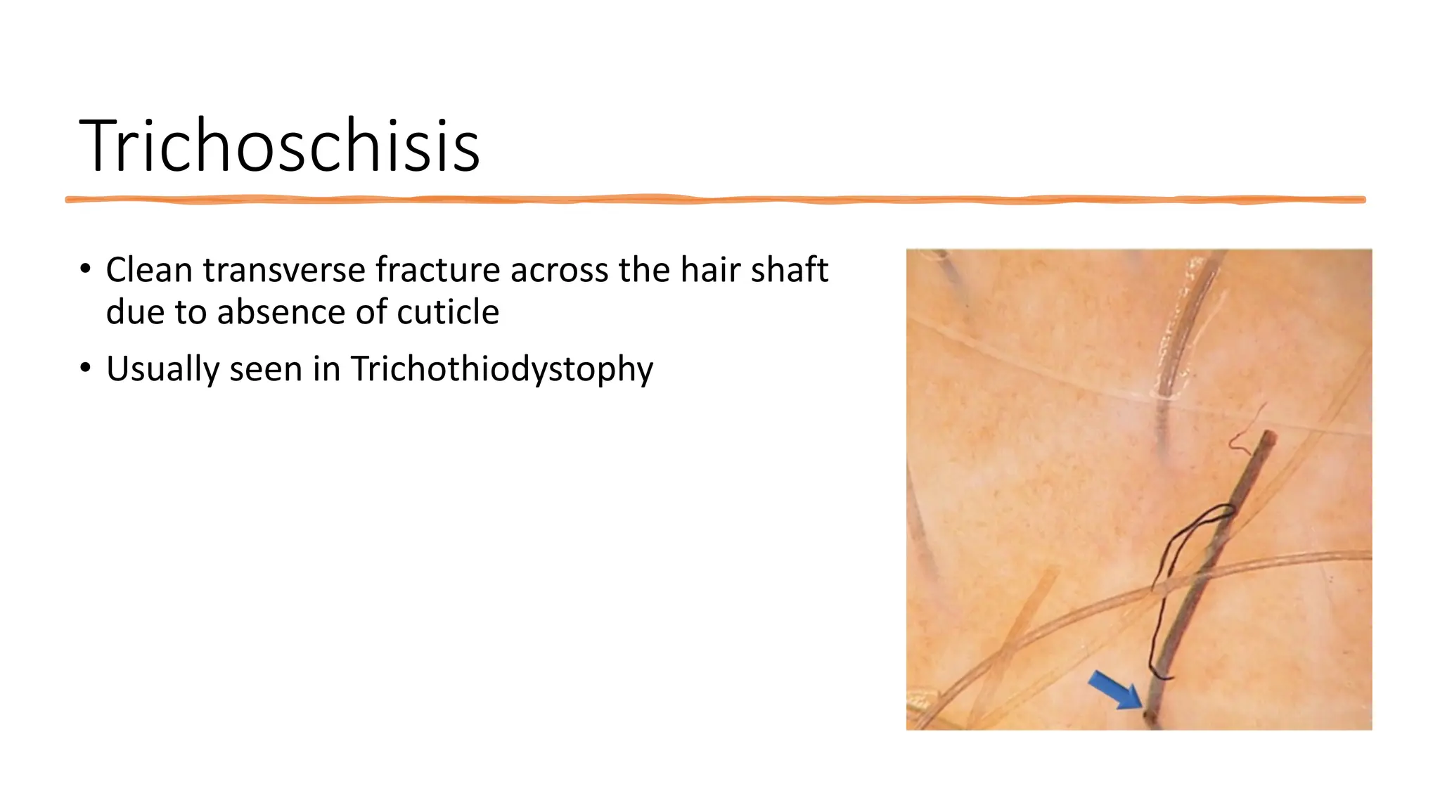 An approach to hair shaft disorders in Dermatology | PDF