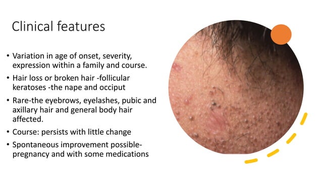 An approach to hair shaft disorders in Dermatology | PDF