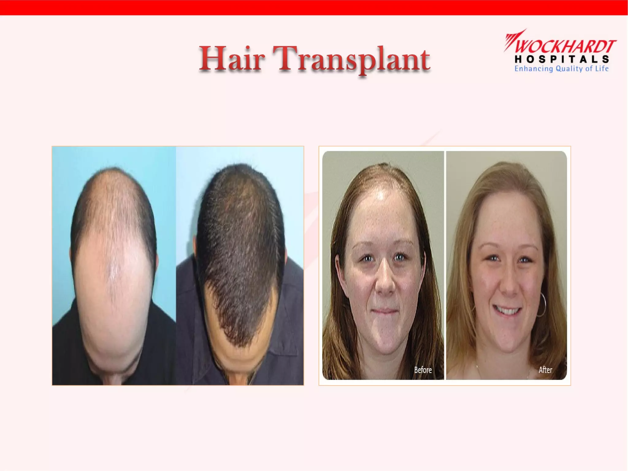 Hair transplant | PPT