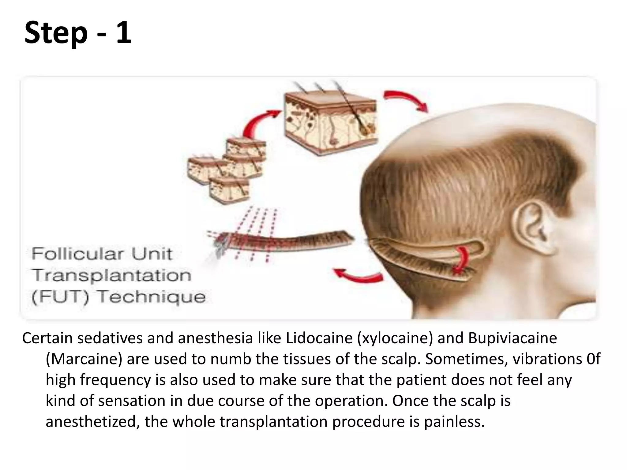 Stages of FUE Process | PPTX