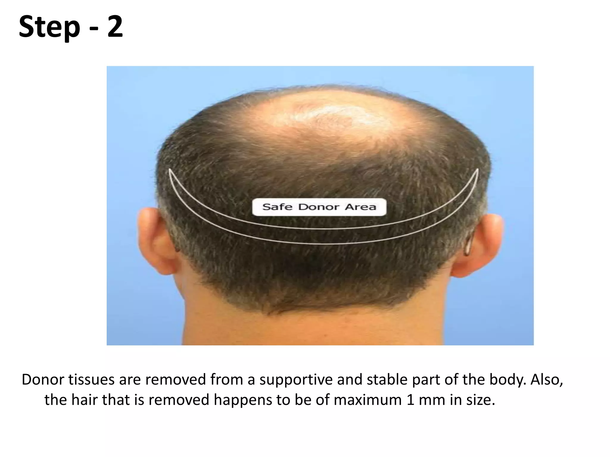 Stages of FUE Process | PPTX