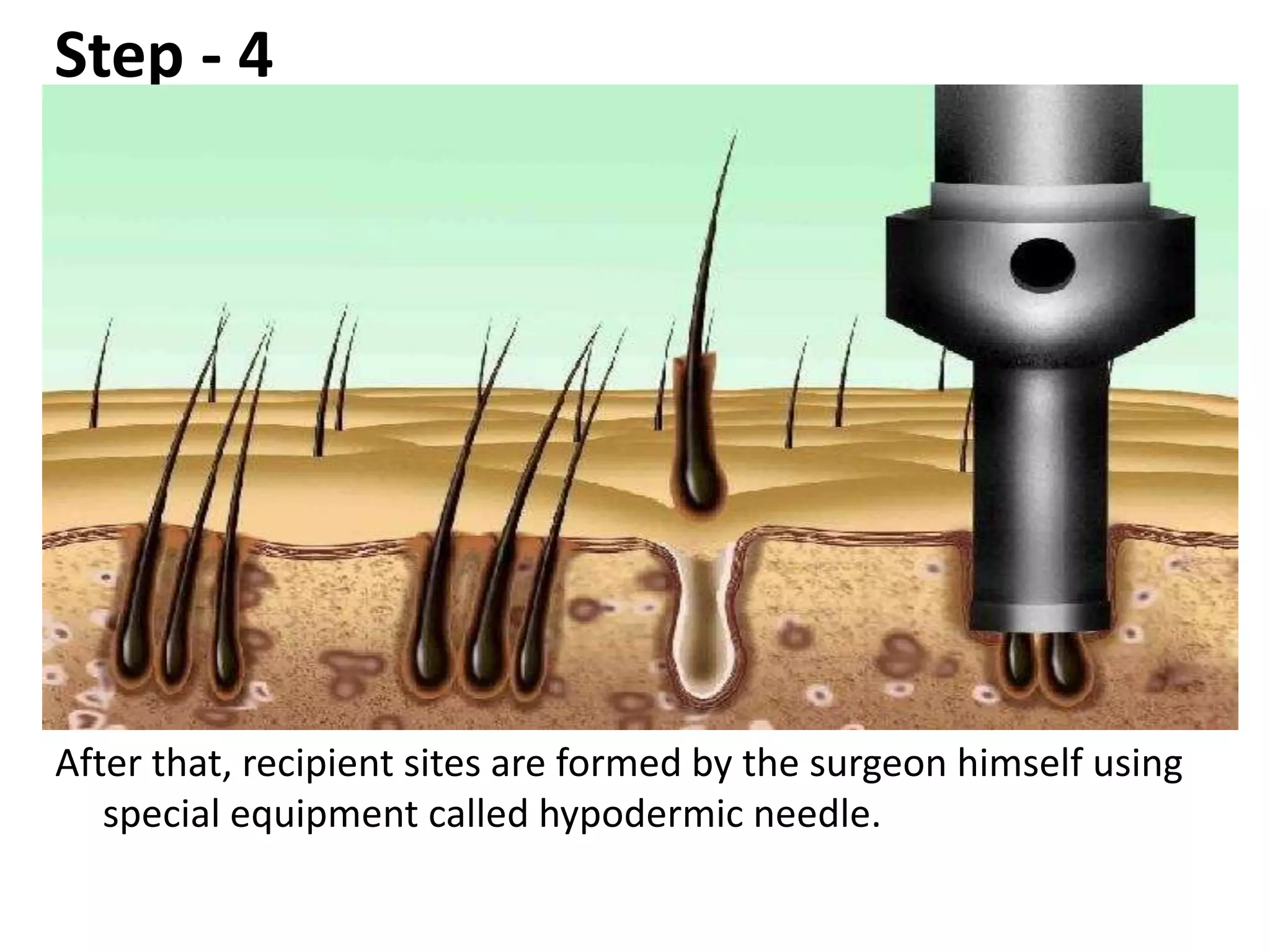 Stages of FUE Process | PPTX