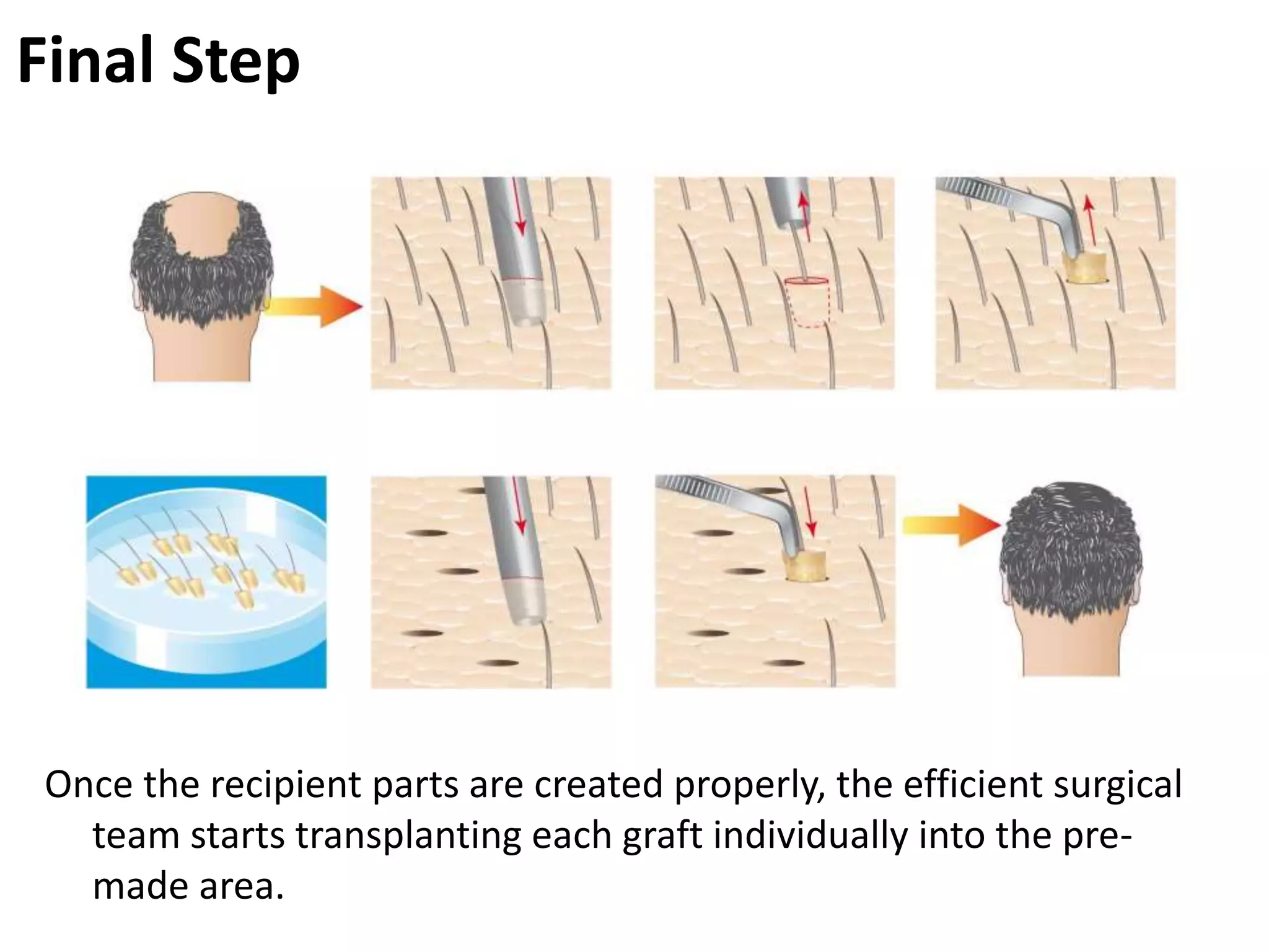 Stages of FUE Process | PPTX